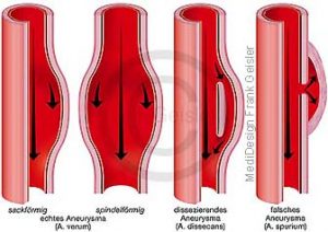 Erkrankung Arterien, Aneurysma