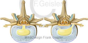 Bandscheibenvorfall, Erkrankung Wirbelsäule