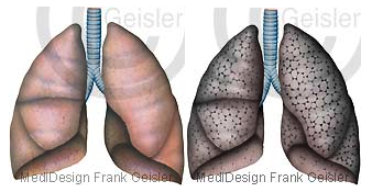 Husten – Hustenreflex, Schutzmechanismus der Atemwege – Anatomie ...