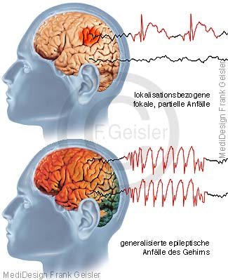 Epilepsie – Fallsucht, Bewusstseinstörungen und Krampfanfälle