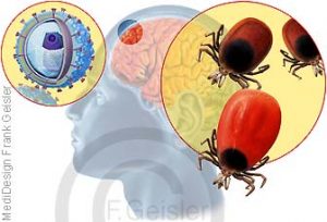 FSME-Infektion durch Zeckenbiss