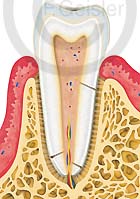 Zahnimplantate – Hinweise zur Zahnimplantation